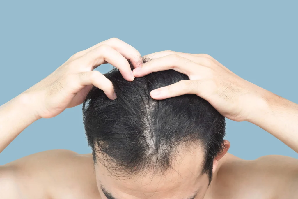 Hair Restoration Tampa | Advanced Hair Loss Treatments at Finlay Medical